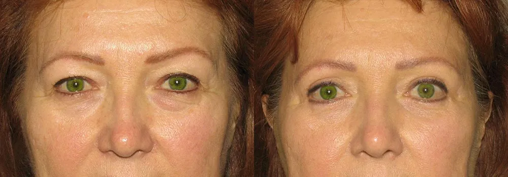 Eyelid Surgery Photos by Guyette Facial & Oral Surgery Center