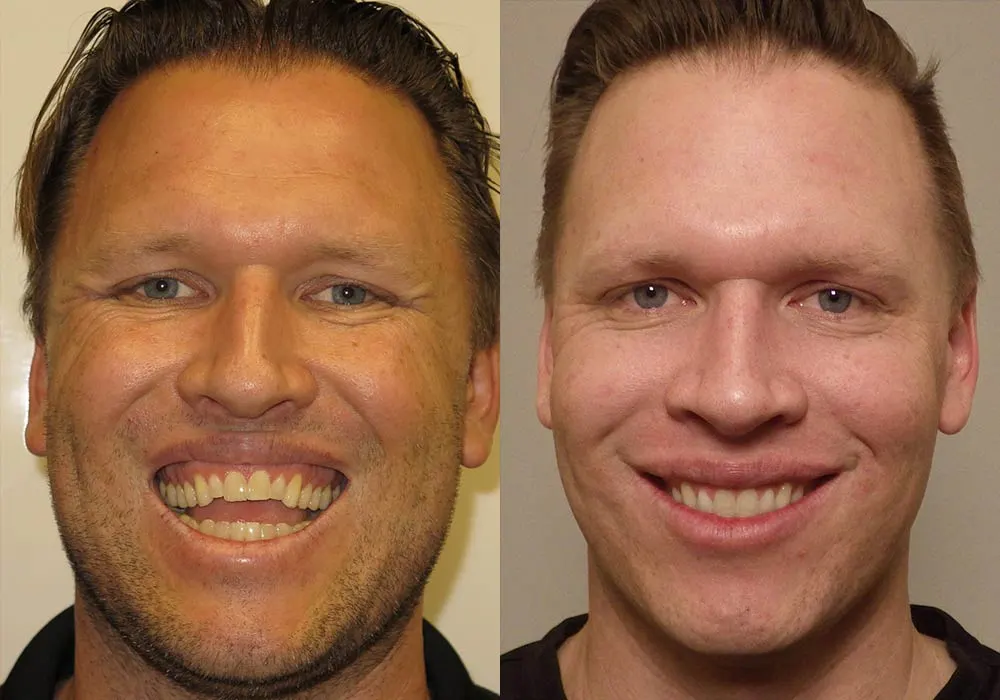 Corrective Jaw Surgery Photo Patient 2