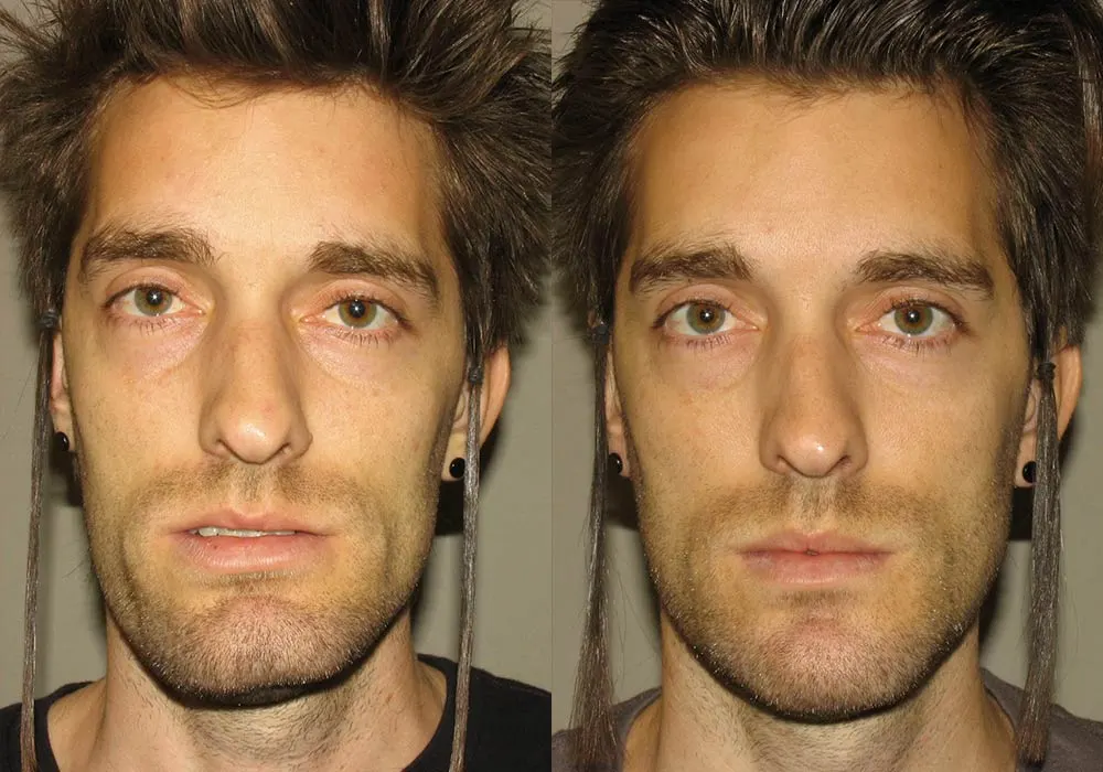 Corrective Jaw Surgery Photo Patient 3