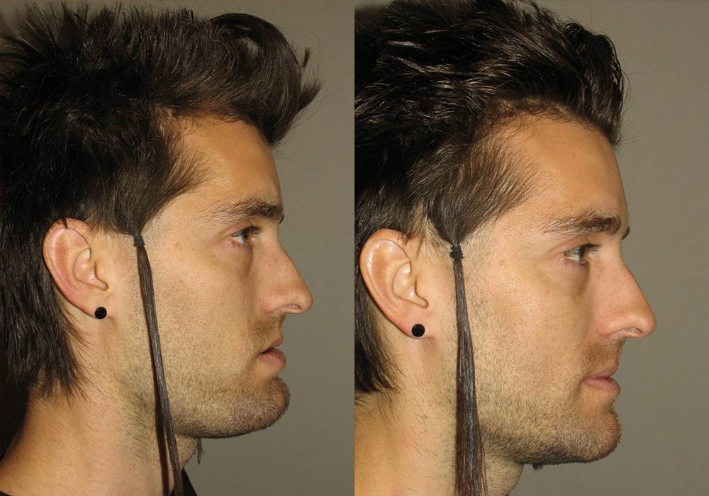 Corrective Jaw Surgery Photo Patient 3