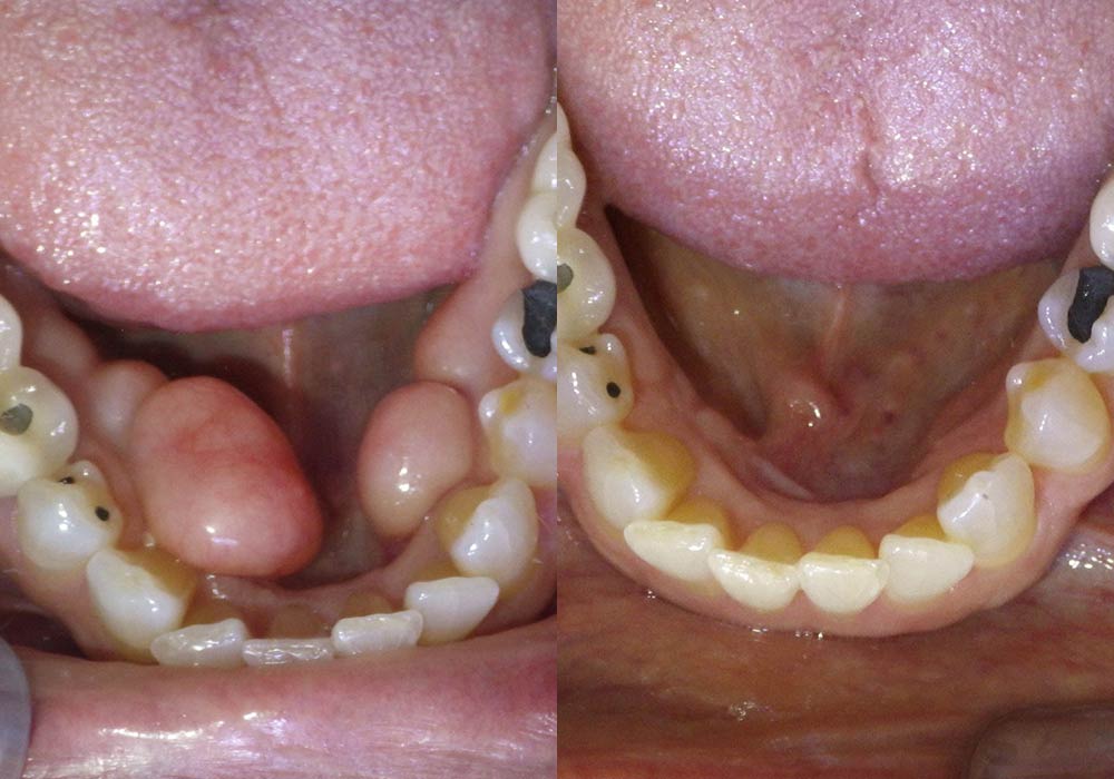 Tori Removal Photos | Guyette Facial & Oral Surgery Center, Scottsdale ...