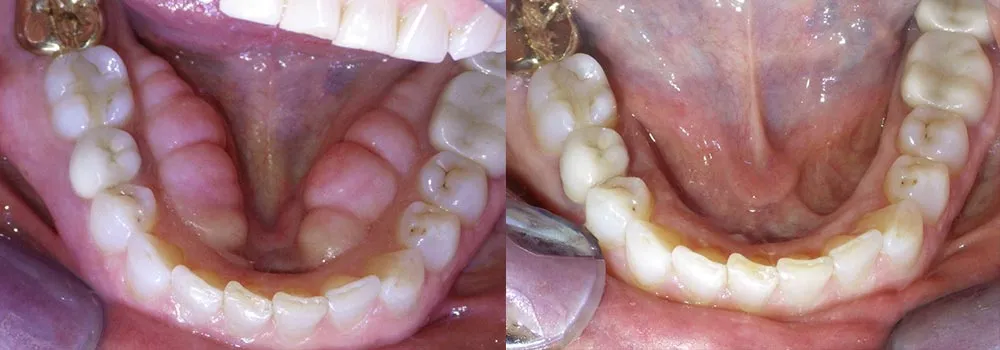 Tori Removal Photo Patient 2